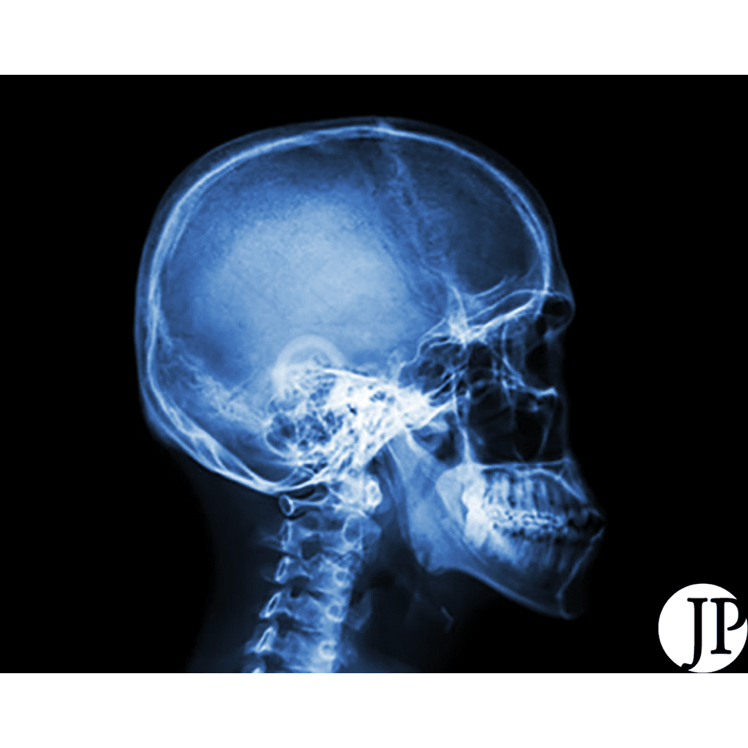 What is the Eggshell Skull Rule? - Paradowski Law
